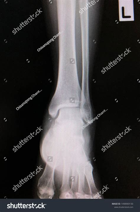X Ray Ankle Ap Foot Ankle And Calf Radiology Key