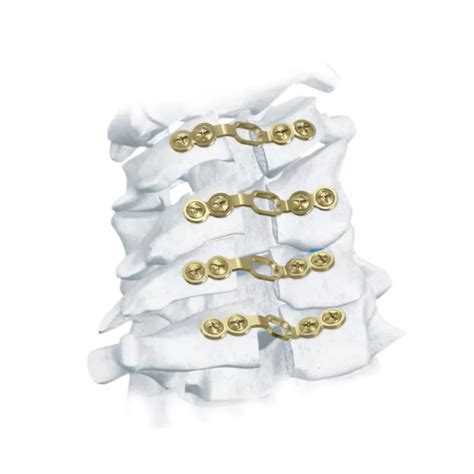 Posterior Cervical Laminoplasty System Credible Solutions Pvt Ltd