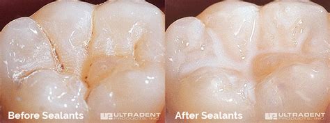 Sealants Dawsonville Distinctive Dentistry