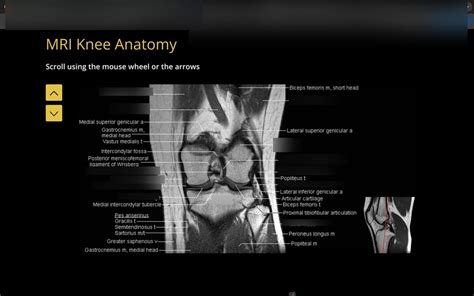 Coronal Knee Diagram Quizlet