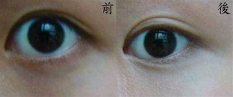 怎樣快速有效的去除黑眼圈 每日頭條