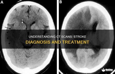 Understanding Ct Scans Stroke Diagnosis And Treatment Medshun