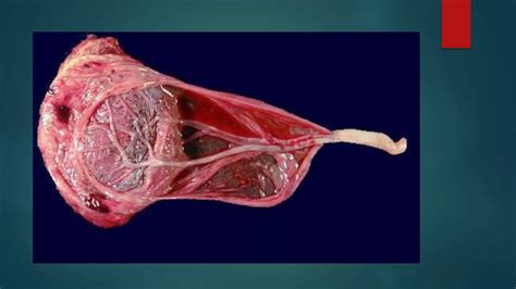 Abnormalities Of Placenta Pptx