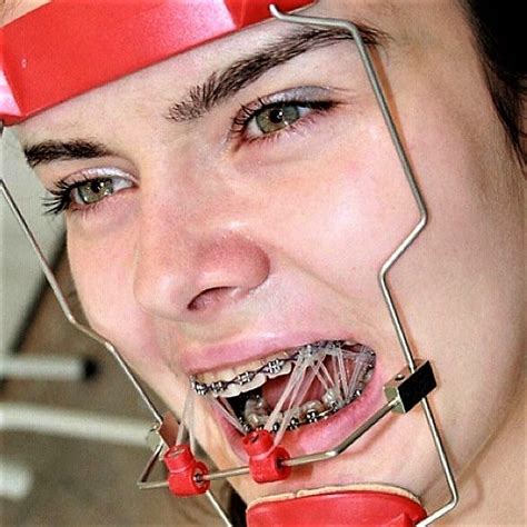 Adult Braces Braces Girls Dental Braces Orthodontic Appliances