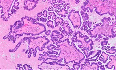 Pathology Outlines Serous Borderline Tumor