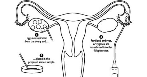 Gamete Intra Fallopian Transfer