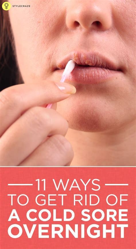 How To Get Rid Of Cold Sores 20 Home Remedies And Other Treatments Cold Sore Get Rid Of