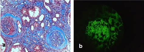 Diffuse Proliferative Lupus Nephritis Ln Who Class Iv A Global