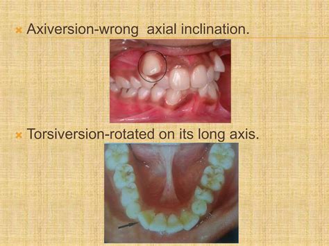 Modifications Of Angle`s Classification Ppt