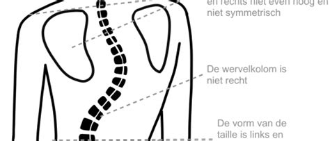 Alles Over Scoliose Symptomen Behandeling