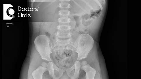 Target Sign Intussusception X Ray Many Plain Radiographic Signs Of
