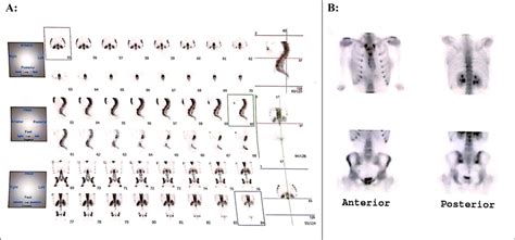 A B Distribution Of The Positive Bone Scan In Case 3 Download