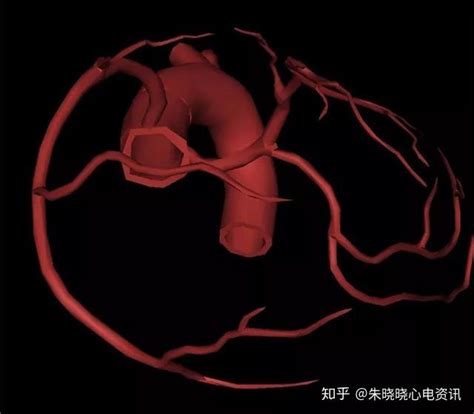冠脉3D图解助你轻松掌握造影体位 知乎