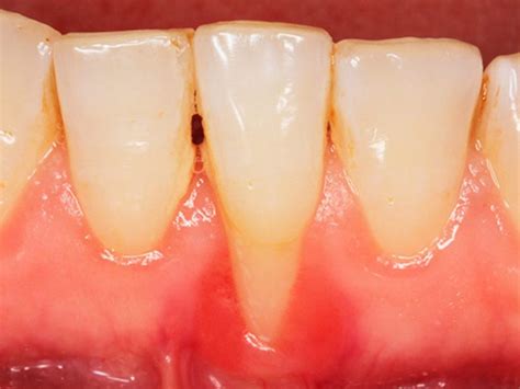Injerto De Encía Tipos Y Posibles Complicaciones Urgencias Dentales