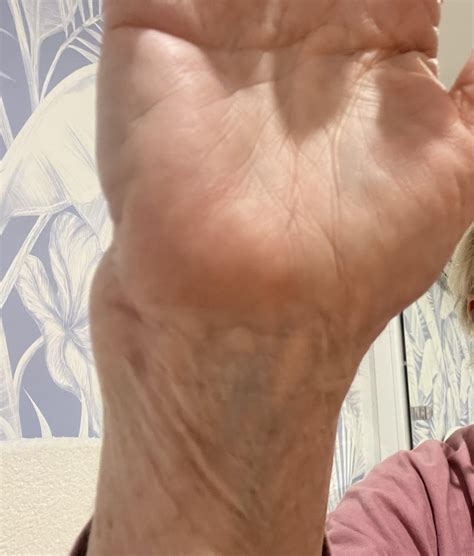 Lump On Wrist Rorthopedics