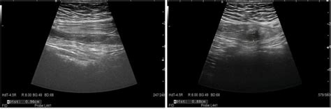 Abdominopelvic Us Persistence Of Urachus Obliterated Distally But