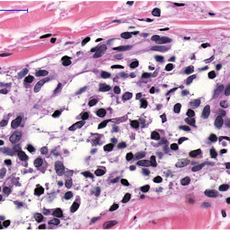 Follicular Pustules Desquamation And Perifollicular Erythema On