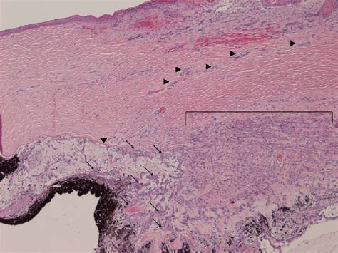 Enucleated Right Eye Specimen Showing Perilimbal Conjunctival Squamous