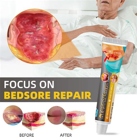 Bed Sore Cream Bedsore Ointment Bed Sores Treatment Ubuy India