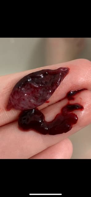 Miscarriage TMI And Trigger Warning What Is What Glow Community