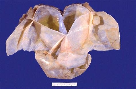 Pathology Outlines Serous Cystadenoma Adenofibroma Surface Papilloma