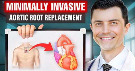 Minimally Invasive Aortic Root Replacement Is It Possible