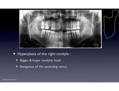 Hemimandibular Hyperplasia And Facial Asymmetry
