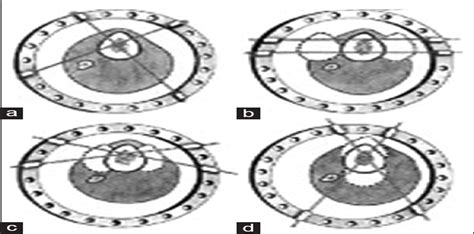 How To Shorten Time In Ilizarov Frame Kerala Journal Of Orthopaedics