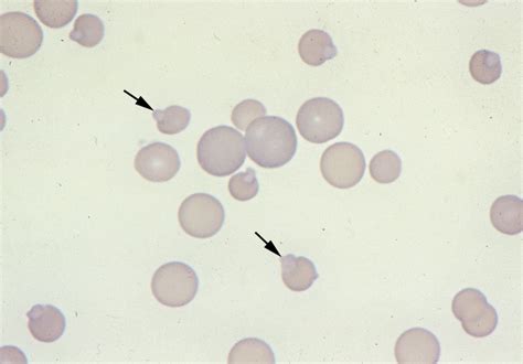 Heinz Bodies Archives Eclinpath