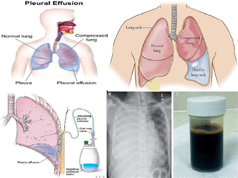 Antibiotics For Pleural Effusion
