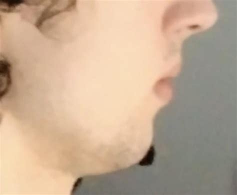 Is My Chin Recessed Rjawsurgery