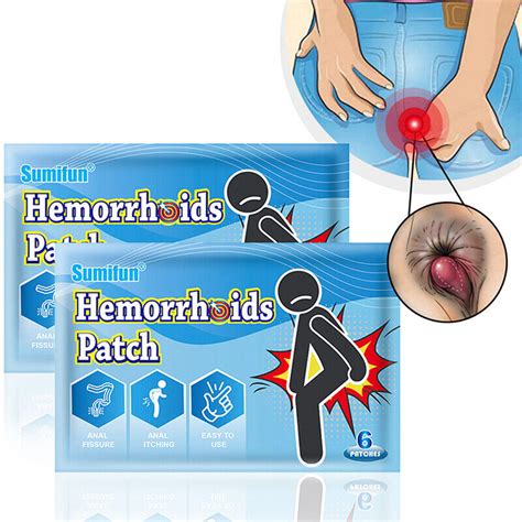 External Hemorrhoid Treatment