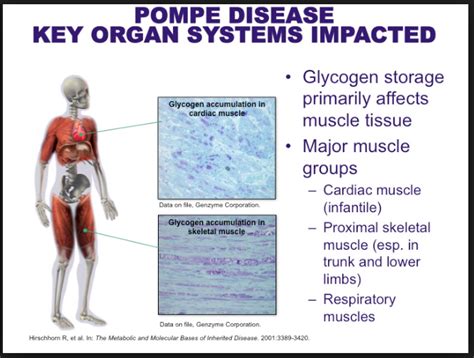 Pompe Disease Also Called Glycogen Storage Disease Type 2 Checkrare