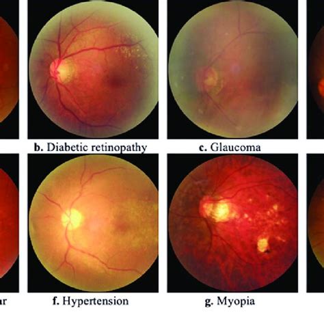 Fundus Images With Diagnostic Keywords And Associated Ocular Diseases Download Scientific Diagram