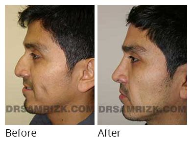 Arabic Nose Job