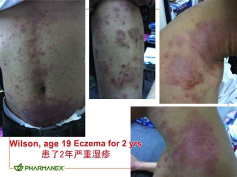 Transformation Health Eczema