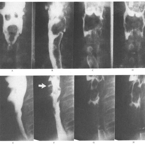 A H A 60 Year Old Woman With Dysphagia There Is Retention Of Barium
