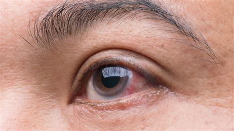 Especialista em Glaucoma em Curitiba Opções de Tratamento para