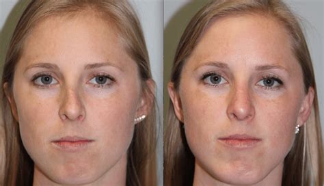 Rhinoplasty Daines Plastic Surgery