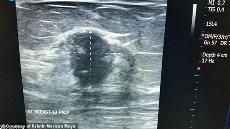 Woman Diagnosed With Breast Cancer At Age 22 Reveals A Mastectomy