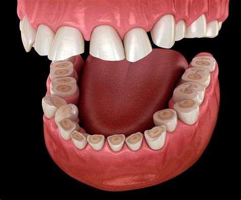 BRUXISMO DENTAL causas síntomas y tratamiento Franqueza dental