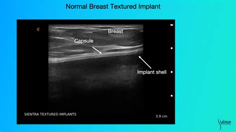 Handheld Ultrasound Is Quick And Safe For The Surveillance Of Silent