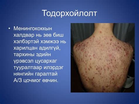 гар хөл амны өвчин Ppt