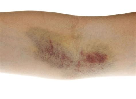Signs Subchorionic Hematoma Resolving 5 Critical Causes Of