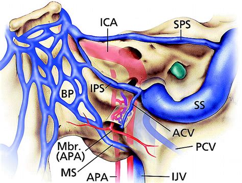 Three Cases Of Dural Arteriovenous Fistula Of The Anterior Condylar