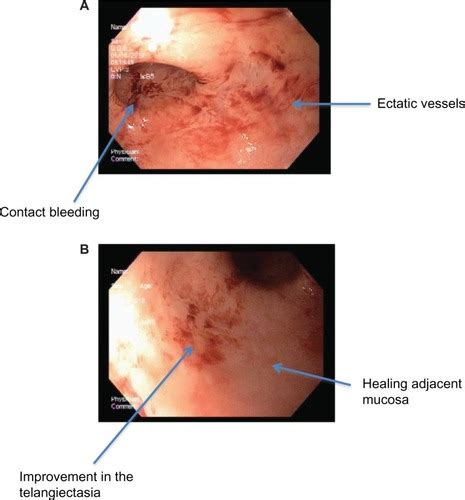 Full Article Radiofrequency Ablation Using Barrx For The Endoscopic