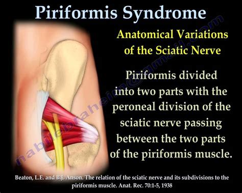 Piriformis Syndrome Sciatica Everything You Need To Know Dr