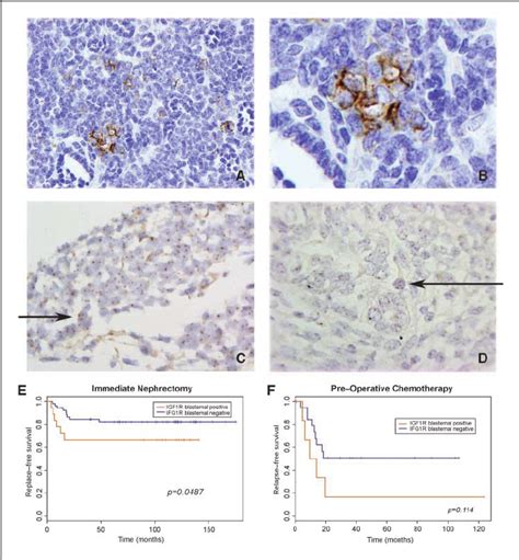 Igfir Expression In The Blastemal Cells Of Wilms Tumors Is Driven By