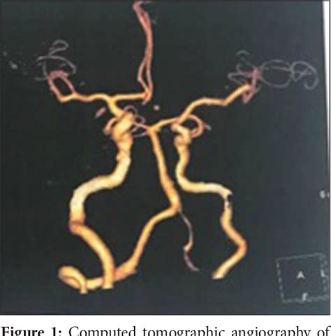 Figure 1 From Right Sided Aortic Arch With Complex Anomalies Presented