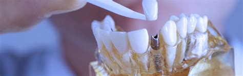 Protocolo Branemark Ponte São João Odontologia Estética